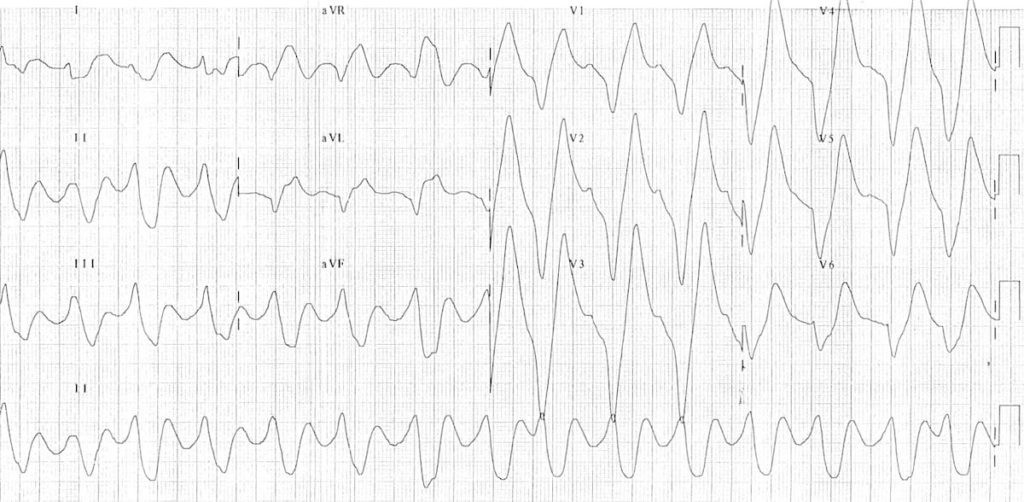 Understanding EKG Findings in Hyperkalemia | Ryan O'Keefe