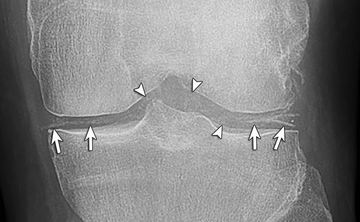 Acute Gout Flare 201 | Ryan O'Keefe